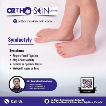Syndacty: Recognising Webbed feet and toes - Ortho and Skin Care Clinic